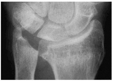 Ulnar Abutment Syndrome