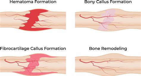 Stages Of Bone Fracture Healing Hematoma Callus Formation And