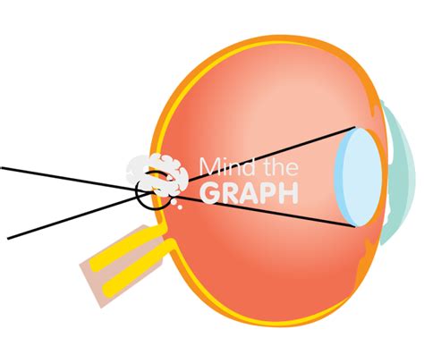 Long Sighted Eye Vision