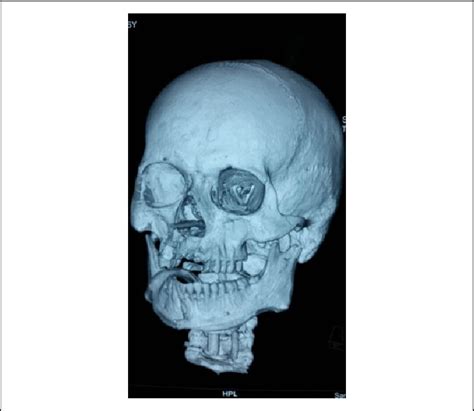 Ct Scan Of Fractured Condyle With Dislocation Ct Indicates Computed Download Scientific