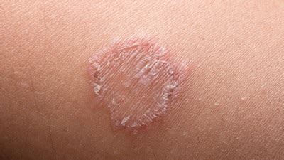 Atrius Health Ringworm