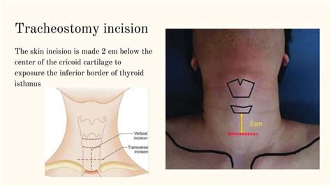Neck Incisions Pptx Thyroid Disorders Endocrine And Metabolic Diseases