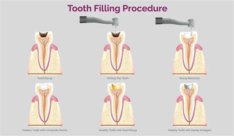 Tooth Filling Vs Root Canal Know Before You Choose