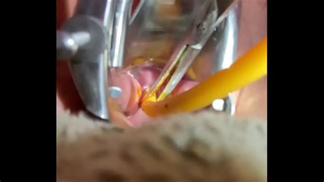 Catheter Insertion Into Uterus Xnxx Com
