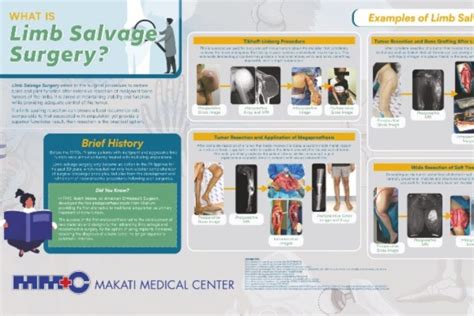 Limb Salvage Surgery Advancements In Care At Makatimed