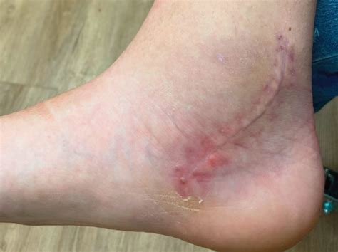 Tarsal Tunnel Release Precise Bioscience