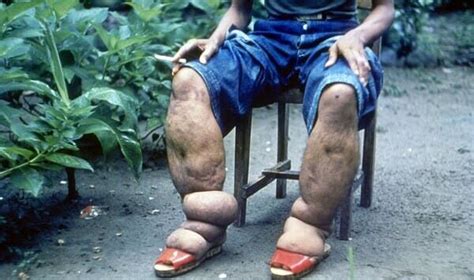 Elephantiasis Bancroftian Filariasis Midwives Revision