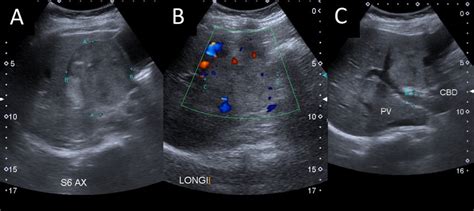 Ultrasound Images Demonstrating A Segment Vi Liver Lesion A Download Scientific Diagram