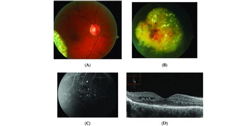 Fundus Photographs A B Fa Image C And Sd Oct Scan D At