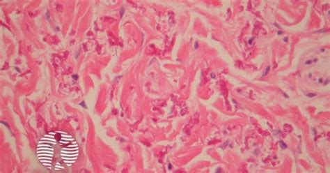 Pseudoxanthoma Elasticum Pathology Image