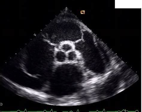 Parasternal Short Axis View At Aortic Valve Level — Printable Worksheet