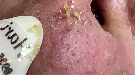 Blackhead Removal Elderly Cystic Acne Pimple Popping Treatment