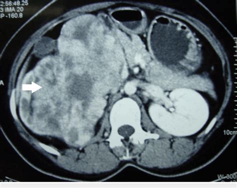 Contrast Enhanced Computed Tomogram Showing The Enhancing Right Renal