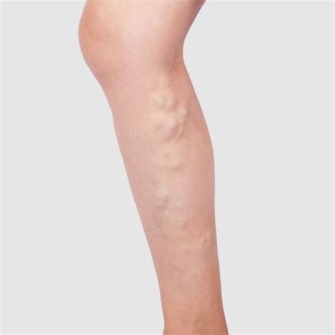 Microphlebectomy Treatment In Sugar Land Tx