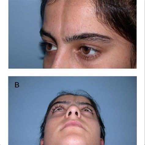 Preoperative View Of The Patient Of Linear Scleroderma A Depressed Download Scientific Diagram