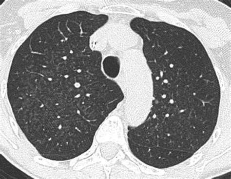 An Algorithmic Approach To The Interpretation Of Diffuse Lung Disease
