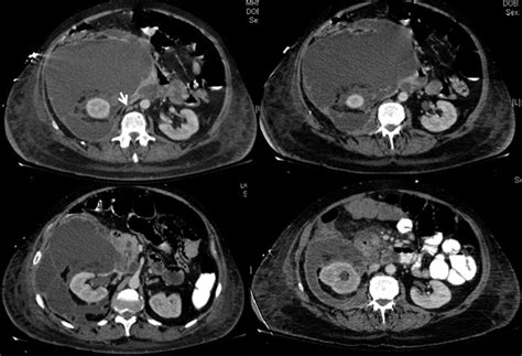 Abdominal Computed Tomography Showing Large Amounts Of Retroperitoneal Download Scientific