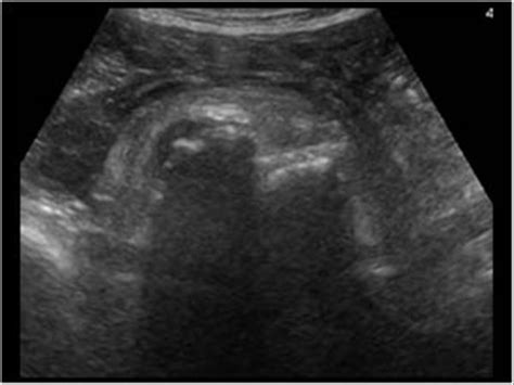 Musculoskeletal Bone Muscle Nerves And Other Soft Tissues 7 1 Bone Case 7 1 2 Exostosis