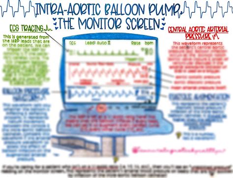 Intra Aortic Balloon Pump Iabp Waveforms Etsy