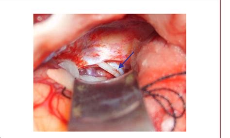 Right Oculomotor Nerve Arrow Crushed Between Midbrain And The