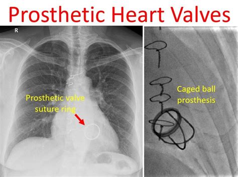 Aortic Valve X Ray At Alyssa Geddes Blog