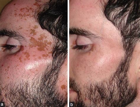 A Patchy Residual Pigmentation On Face B After Treatment With