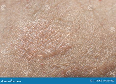 Large Plaque Parapsoriasis On Caucasian Man Legs Stock Image Image Of