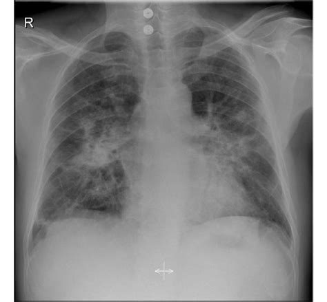 Chest X Ray Showing Worsening Of The Previously Noted Bilateral Patchy Download Scientific