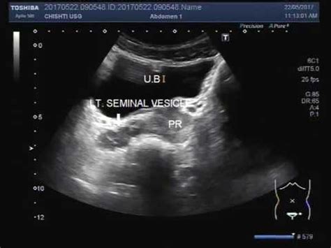 Ultrasound Video Showing An Enlarged Seminal Vesicles With Uti Youtube