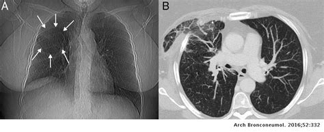Postsurgical Intercostal Lung Herniation Archivos De Bronconeumología