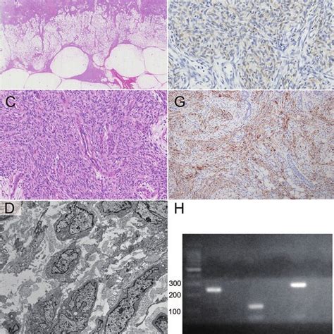 A Clinical Appearance Of The Tumour On The Left Buttock B A Poorly