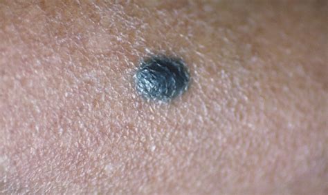 Cancerous Black Moles