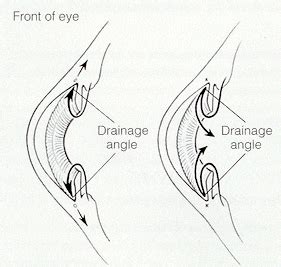 What Causes Narrow Angle Eye