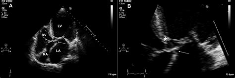 Achd Echo Protocols Congenital Heart International Professionals Chip Network