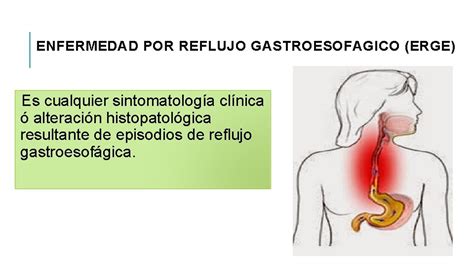 Enfermedad Por Reflujo Gastroesofagico Erge Maria Cristina Blanco