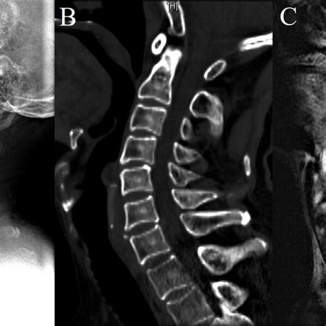 Castellvi Classification Of Transitional Lumbosacral Vertebra Tlv Download Scientific Diagram