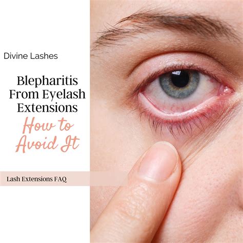 Blepharitis From Eyelash Extensions How To Treat And Prevent