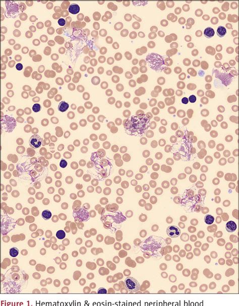 Figure 1 From Leukostasis In Chronic Lymphocytic Leukemia Semantic