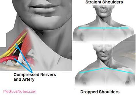 Drooping Of The Shoulder