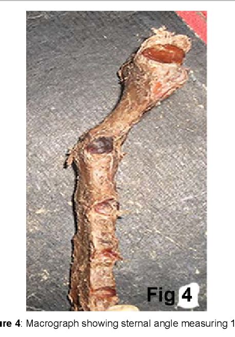 Sternal Angle