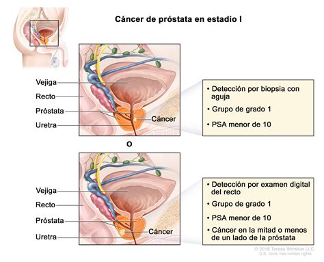 Etapas Del Cáncer De Próstata Biopsia De Próstata Dr Juan Carlos