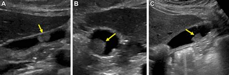 Management Of Incidentally Detected Gallbladder Polyps Society Of