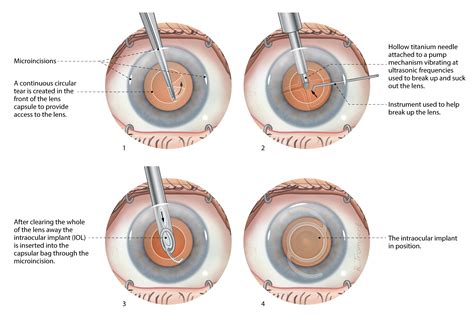 Escrs Cataract Surgery