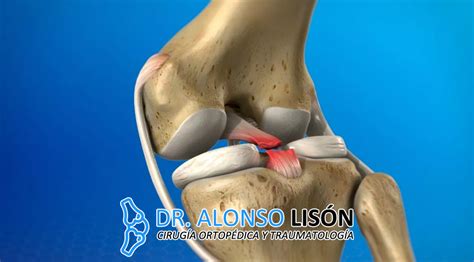 Rotura De Ligamento Cruzado Anterior De La Rodilla Auto O Aloinjerto