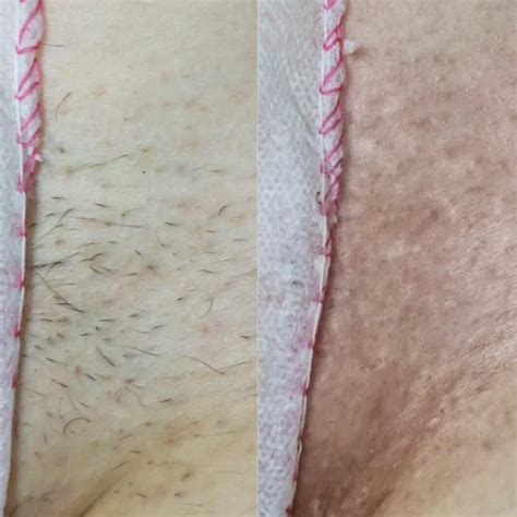 Bikini Laser Hair Removal In Melbourne