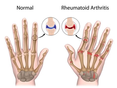 How Can Physical Therapy Help Your Arthritis Sapna Pain Management Blog