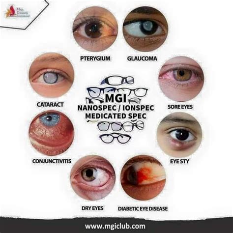 Eye Diseases Chart