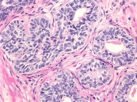 Basal Cell Hyperplasia Higher Magnification