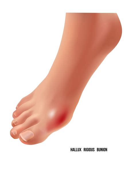 Hallux Rigidus Physioflow Pt Physical Therapy Vancouver Wa