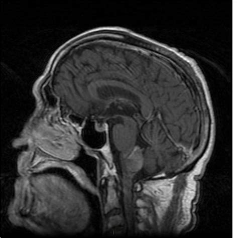 Cavernous Venous Malformation Pacs